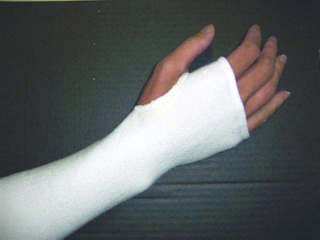 Splint Sock, Coolmax with Thumb Spica | Protection & Comfort